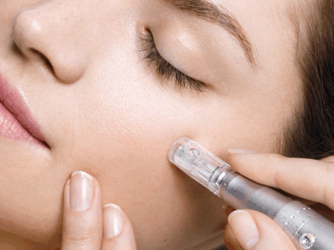 Microneedling behandeling tegen rimpels, littekens en pigmentvlekken